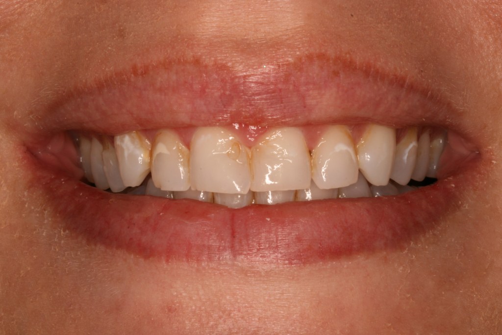 Understanding Dental Mottling: Causes and Solutions | Contemporary ...