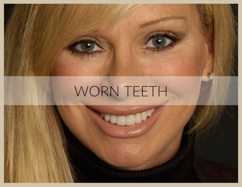 Gallery of Worn Teeth | Contemporary Cosmetic Dentistry